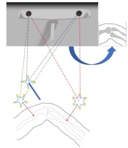 Real-Time Navigation System in Innovative Orthopedic Surgery Procedure