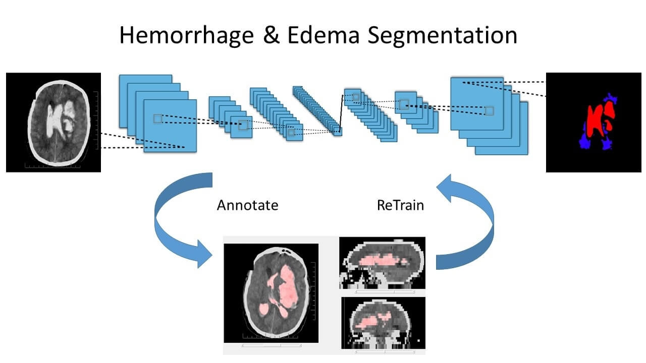 Intracranial Hemorrhage And Edema Segmentation With Deep Learning