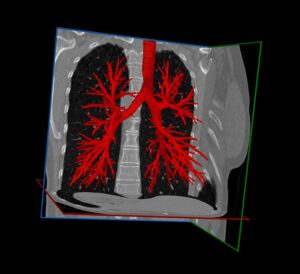 Lung Segmentation with Unmatched Precision for Lung Procedures