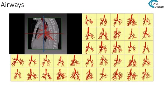 Ai Based Segmentation In Ct By Rsip Vision