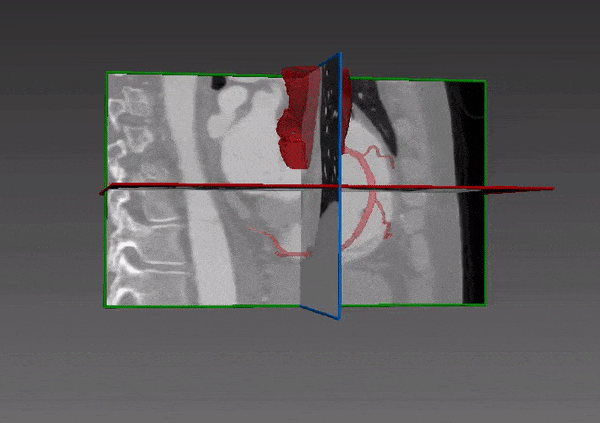 AI in Cardiac CT Angiography with Deep Learning by RSIP Vision