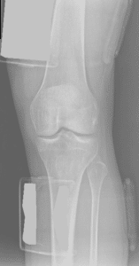2D-to-3D Knee Bones Reconstruction with AI by RSIP Vision