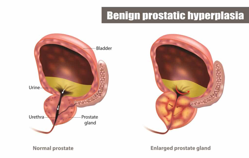 AI for Benign Prostatic Hyperplasia BPH by RSIP Vision