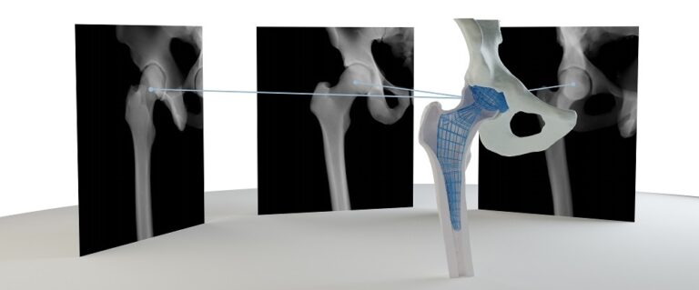 XPlan.AI - DL-based 2D-to-3D Joint Reconstruction from X-ray