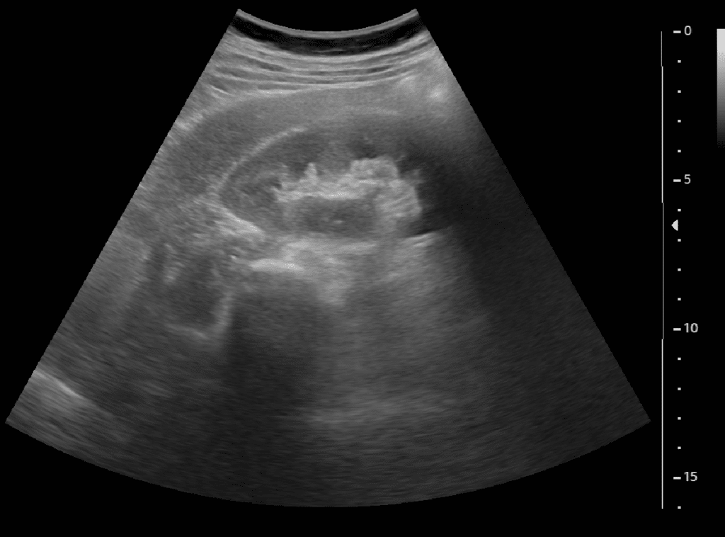 Improved PCNL with Computer Vision by RSIP Vision